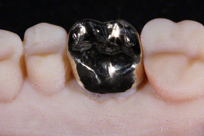 full gold crowns Archives - Williams Dental Lab